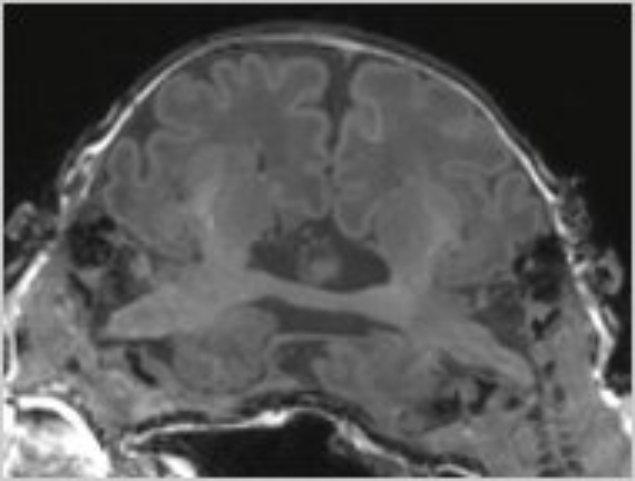 11-year-old conjoined twins have a connected brain, see through each ...