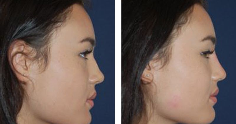 botoxlondon: Painless nose reshaping without cuts!
