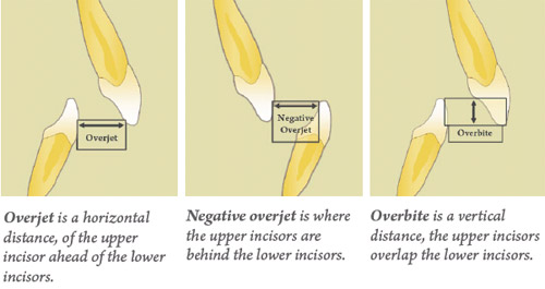 Wheeler Orthodontics' Blog: Two-Phase Orthodontic Treatment: Everything ...