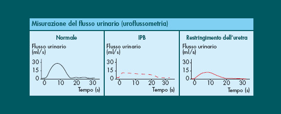 UROFLUSSOMETRIA : ESAME URODINAMICO