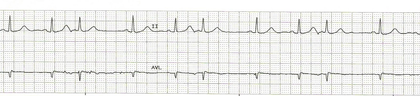 EKG Rhythm Strip Quiz 64