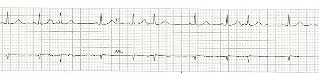 EKG Rhythm Strip Quiz 64
