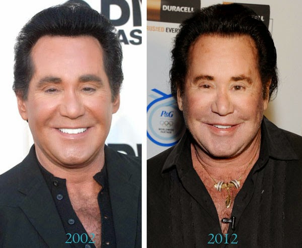 Wayne Newton Plastic Surgery Botox Injections, Nose Job Before and After