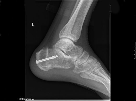 ESPOLON DE HAGLUND-SEVER