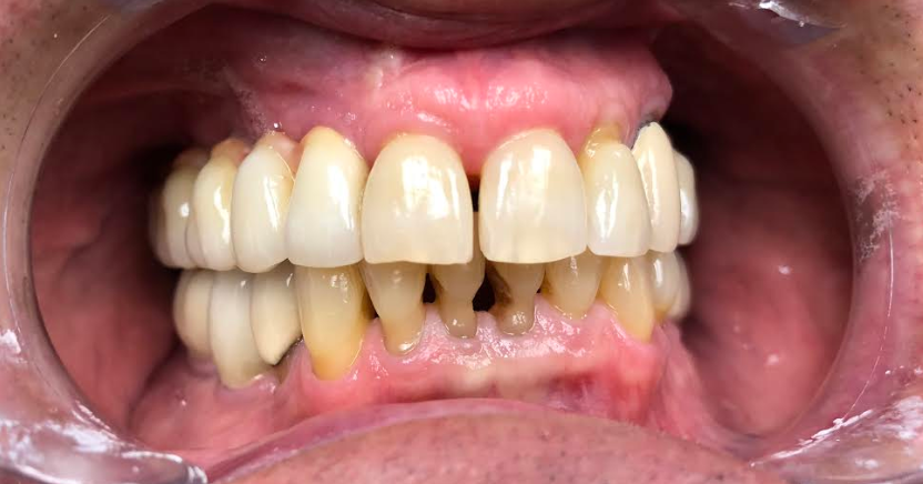 Immediate Dental Implant Placement in the Anterior Aesthetic Zone