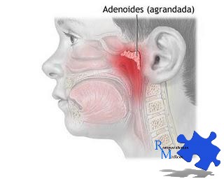 Hipertrofia de adenoides ~ Rompecabezas Médicos
