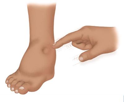 Blog da Clínica José Fontes - Porto: Edema