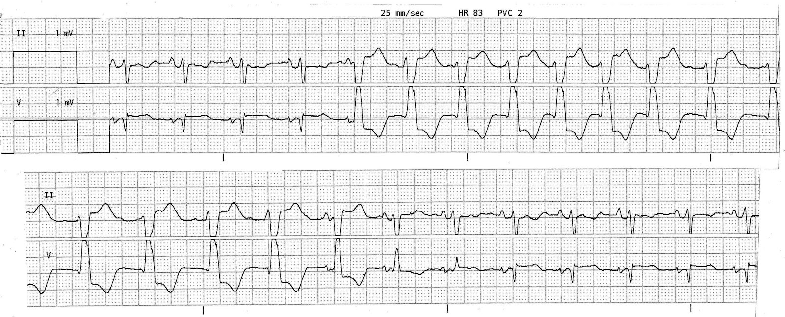 Accelerated Ventricular Rhythm ECG Learning Center An Introduction