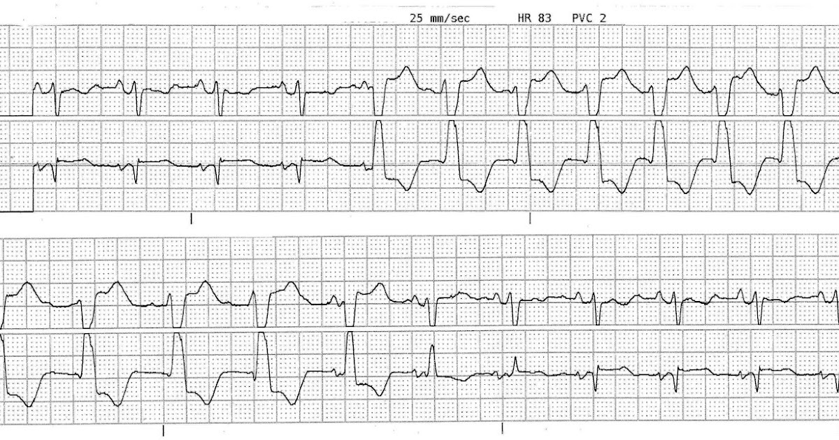 ECG Rhythms: AIVR/VT or Aberrancy?