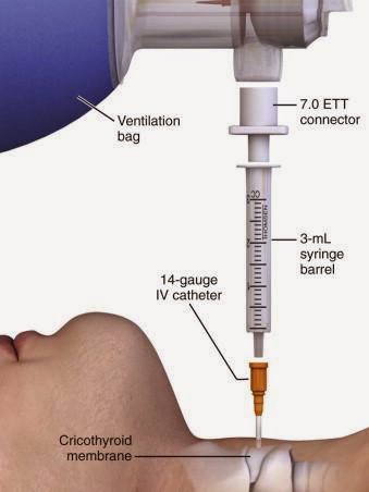 Procedures Club: Surgical Airway, Part Two: Pediatric Translaryngeal ...