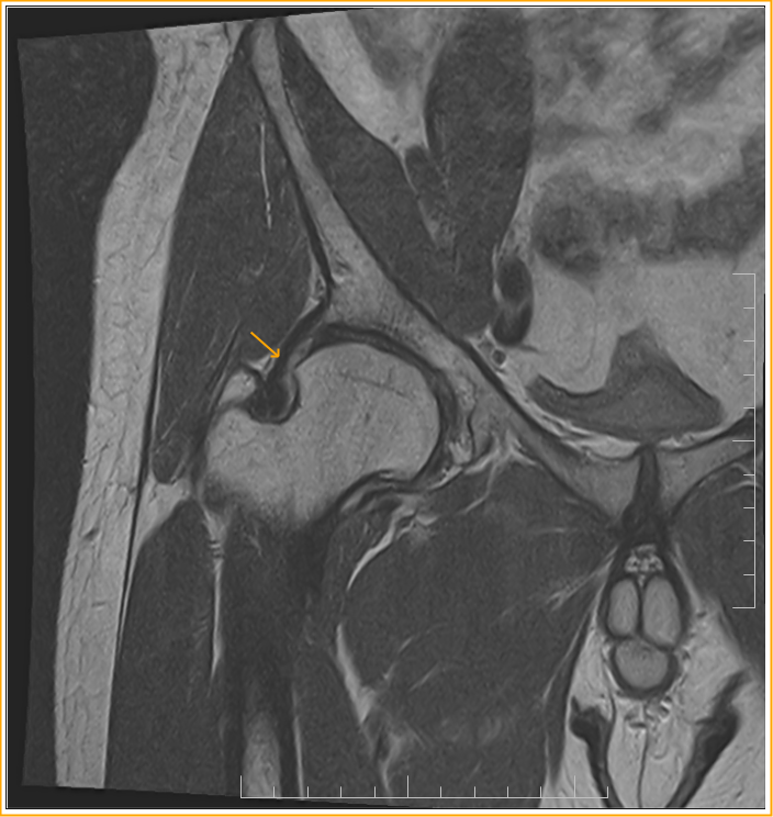 Acetabular Cyst with Femoro-acetabular impingement - Sumer's Radiology Blog