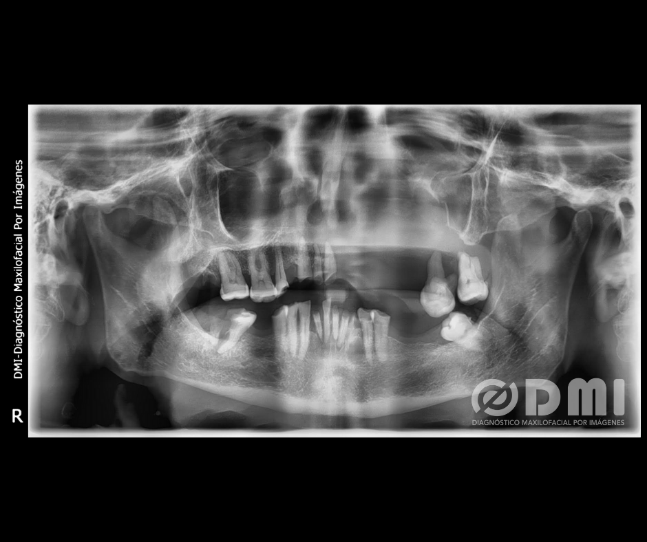 Diagnóstico Maxilofacial por Imágenes: Caso 16 _ Neoplasia maligna en ...