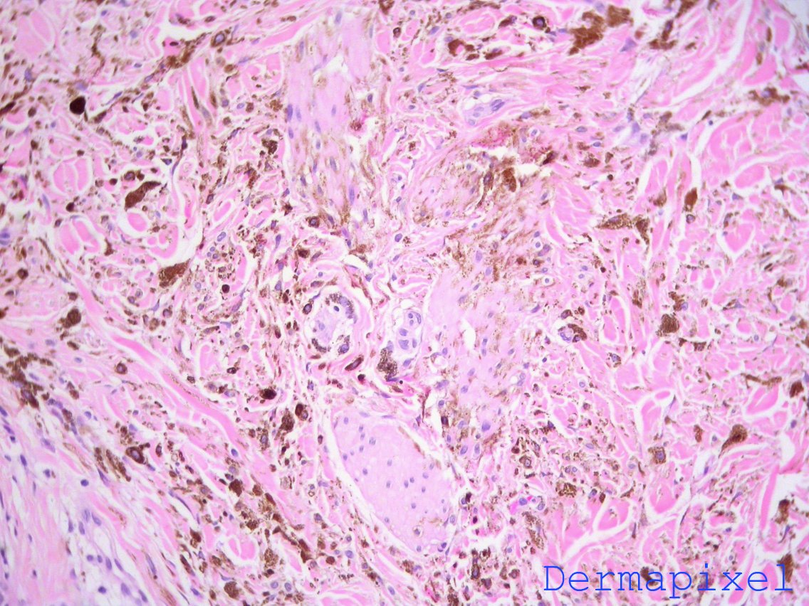 Dermapixel: Cuando los nevus, como los príncipes, son azules