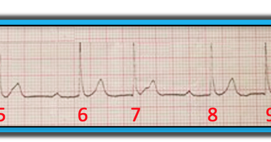 ECG Interpretation: ECG Blog #164 (PACs — Blocked PACs — Wenckebach ...