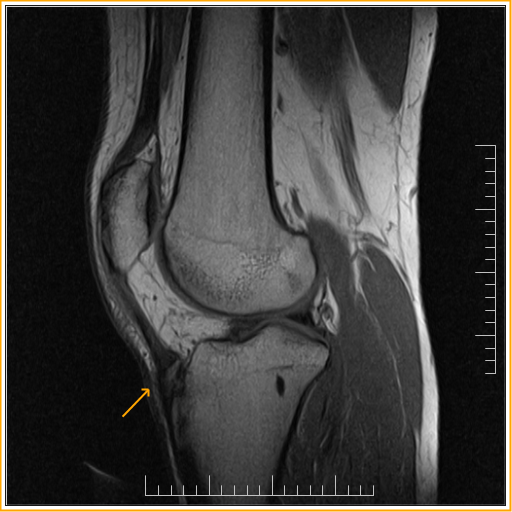 Osgood Schlatter disease-MRI - Sumer's Radiology Blog