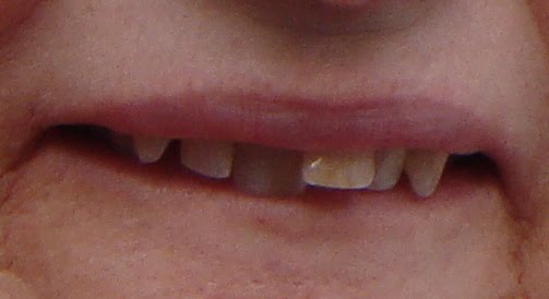 Braces at 56: Read About Early Days with Inspire Ice Clear Brace