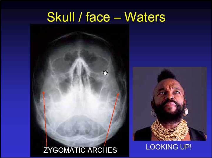 Aditya Radiografer II: Proyeksi Waters Close mouth