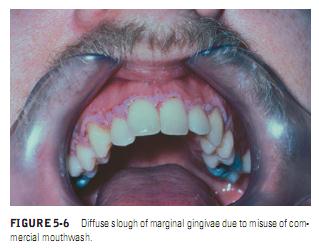Burket’s Oral Medicine: Chemical Injuries of the Oral Mucosa
