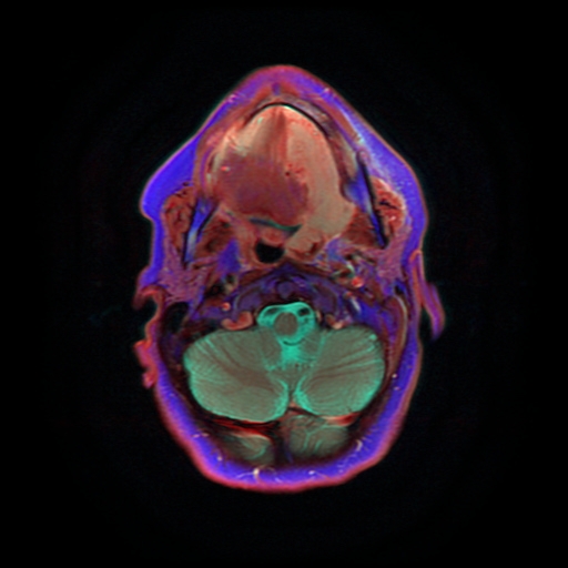 Nevit's blog: Color MRI - Lymphoma of the Neck