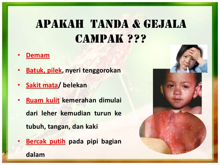 Obat Herbal Penyakit Campak Yang Ampuh Mengatasinya | Obat Herbal Terbaik