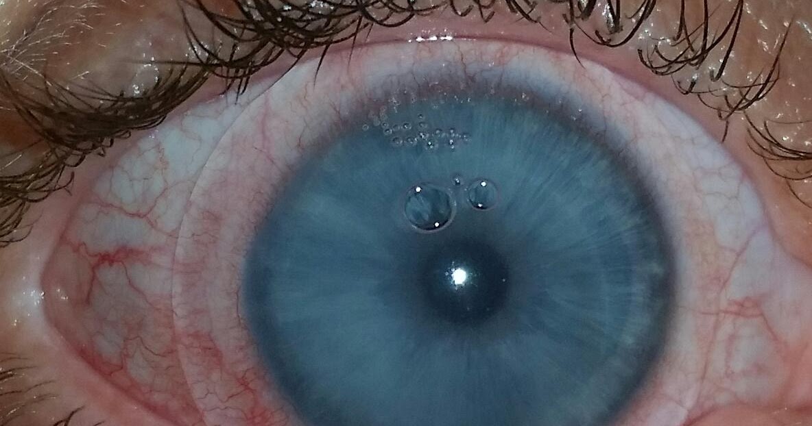 A Keratoconus Patient Struggles With Scleral Lenses Keratoconus Group