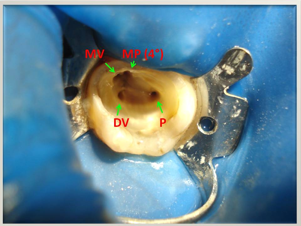 ENDODONCIA Casos Clínicos: SEGUNDO MOLAR SUPERIOR CON 4 CONDUCTOS ...