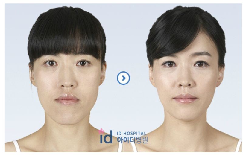 ID Hospital Korea: [korea plastic sugery] long face surgery(before and ...