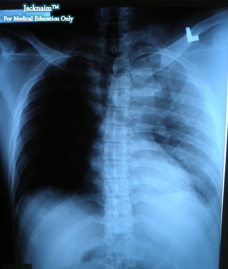 My Medical Notes: Image of the Day 5: Left Hemothorax