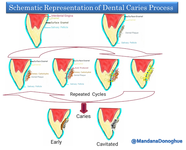 Oral Pathology India: CARIES VS. EROSION
