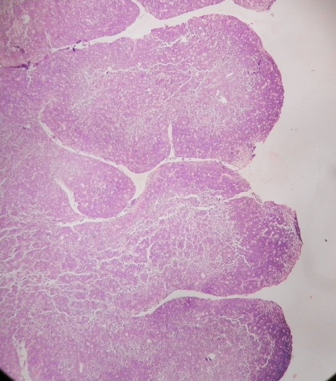 into the roots: Lymphomas