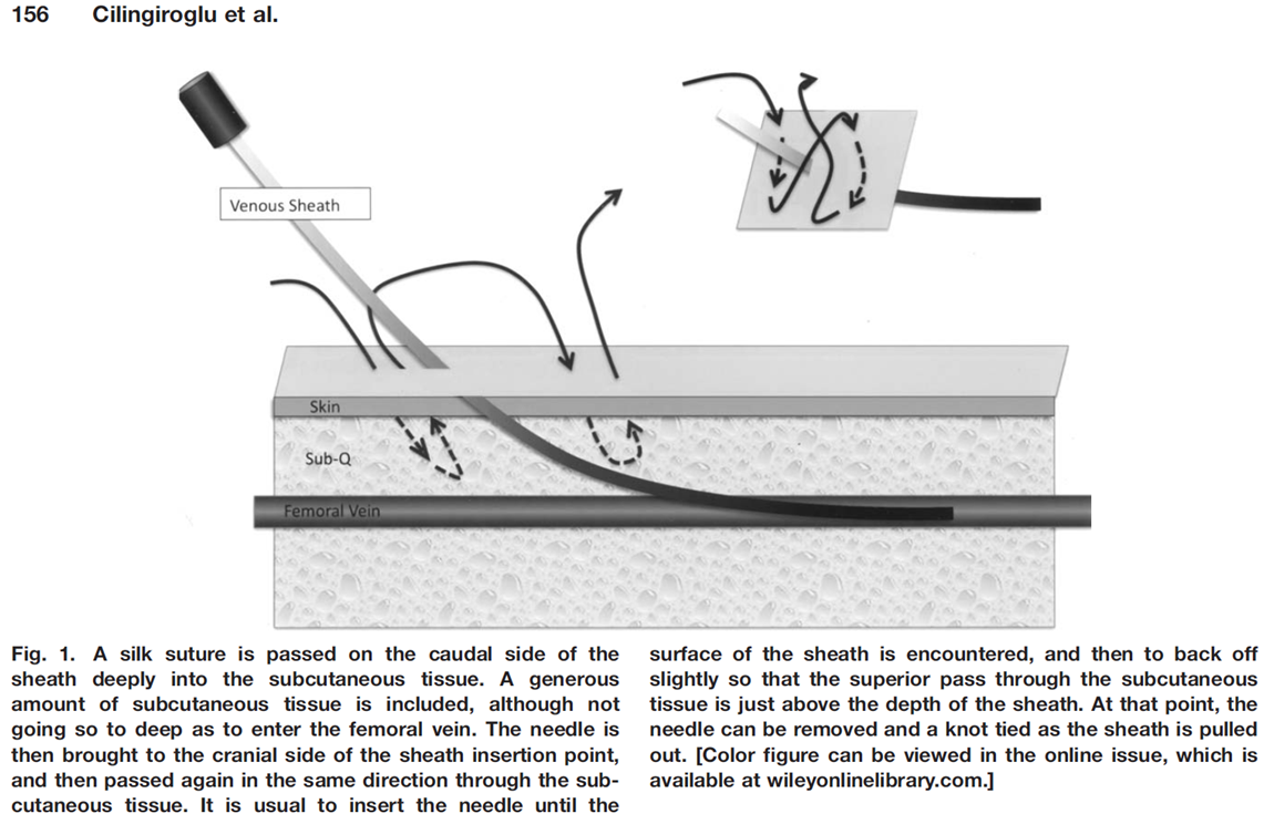 Journal Club: Figure-8 stitch - For Hemostasis of femoral vein access