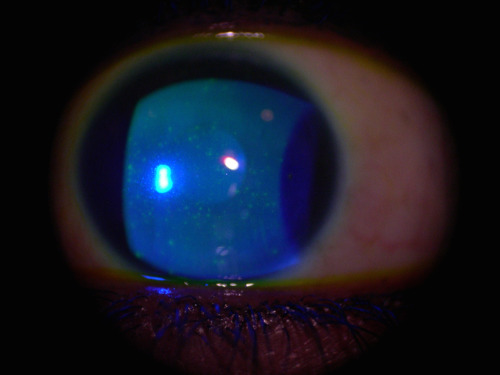 dry eye knowledge: Dry eye testing and SPK