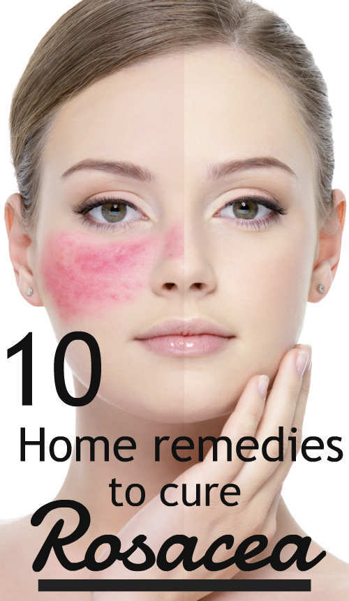 10 Best Home Remedies to Cure Rosacea - TOP 5 DIY
