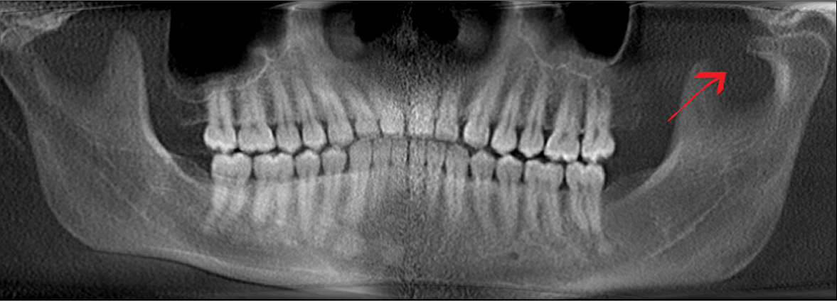 DrChetDMD: Unilateral Condylar Hyperplasia