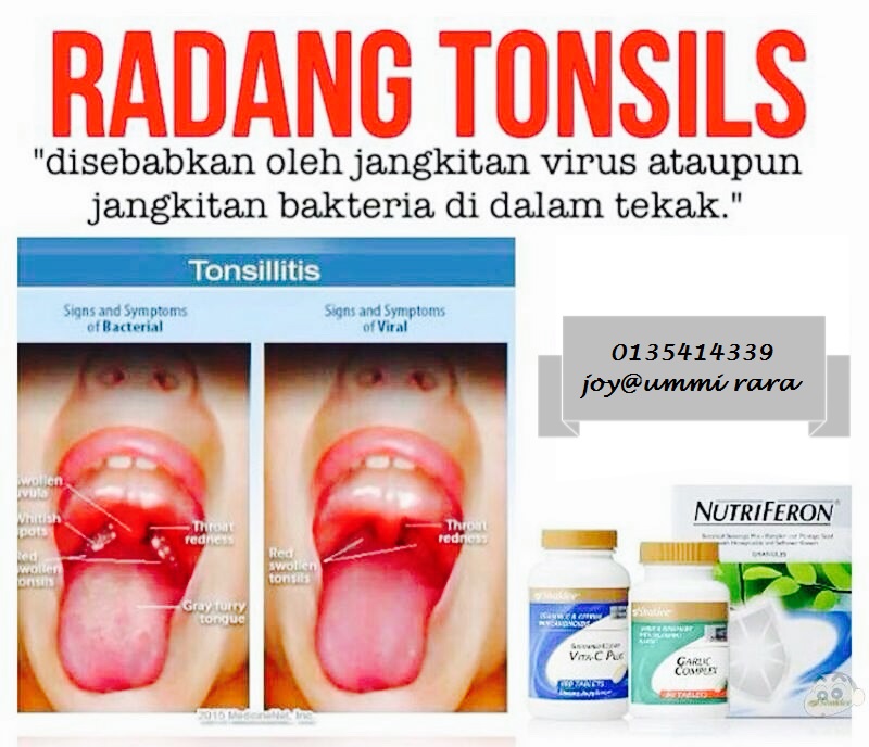 *UMMI RARA LIFE STORY*: BILA RADANG TONSIL MENYERANG SERTA RAWATAN ...