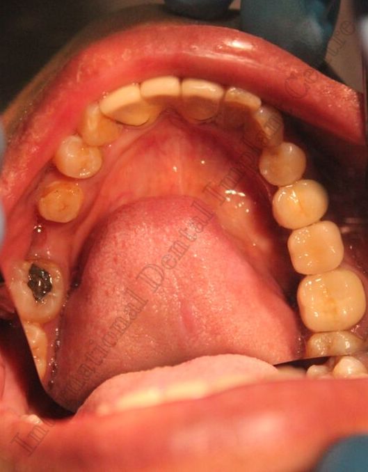 DR Murugavel's dental implant course: Upper and lower missing molar ...