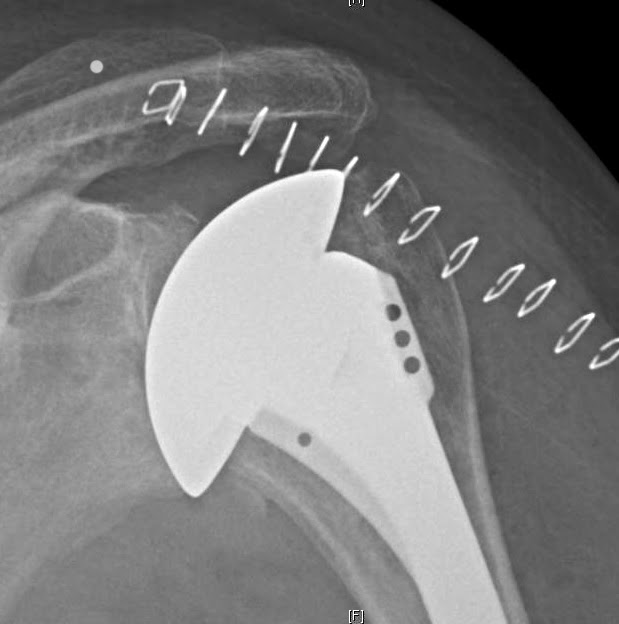 UW Shoulder and Elbow Academy: Fixed posterior subluxation - management ...