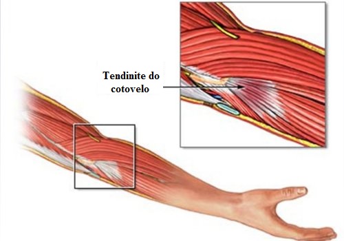 Blog do Zé Lopes: DIAGNOSE - DICA DE SAÚDE - TENDINITE