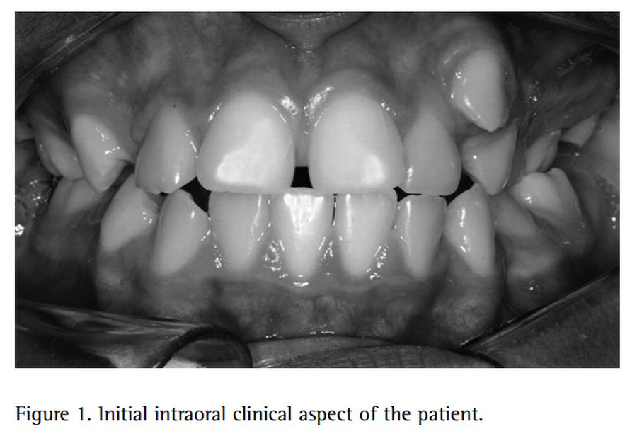 PDF: MULTIPLE SUPERNUMERARY TEETH in a Nonsyndromic 12-Year-Old Female ...