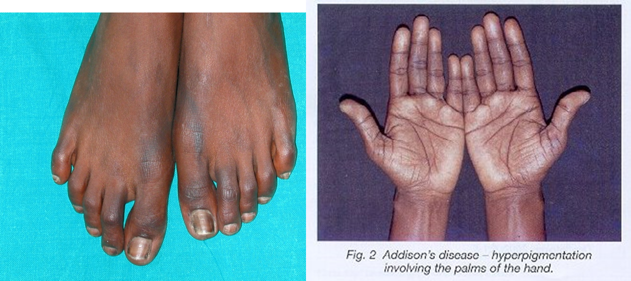 ADDISON'S DISEASE: CAUSES, RISKS, DIAGNOSIS & TREATMENT ...