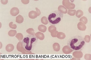 Hematología Fichas: Banda o Cayado