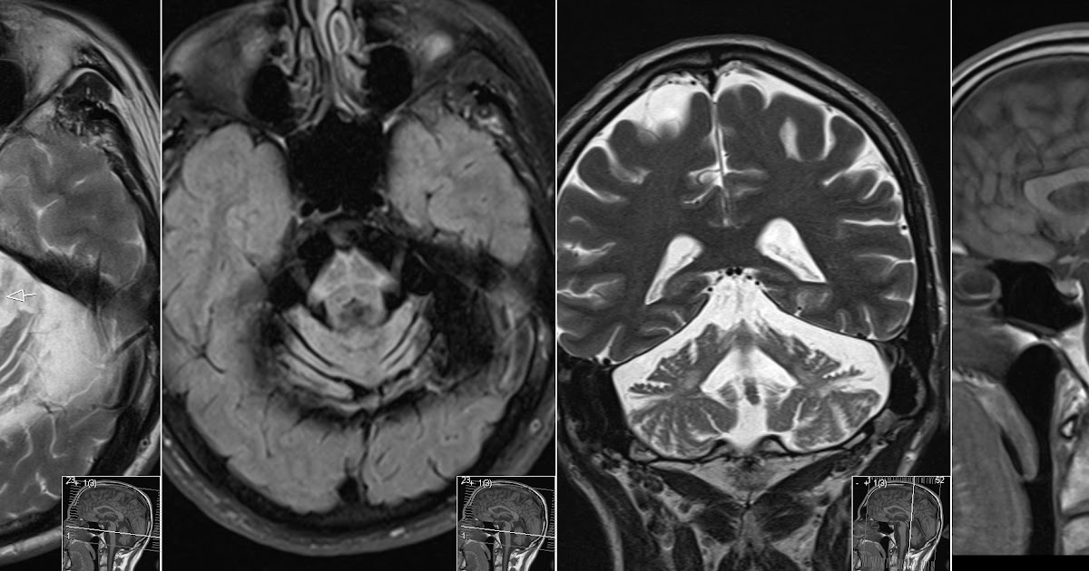 Radiology MRI: Hot Cross Bun - MSA