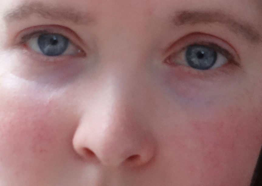 Scarlet Letters, dealing with vascular rosacea, face flushing, burning ...