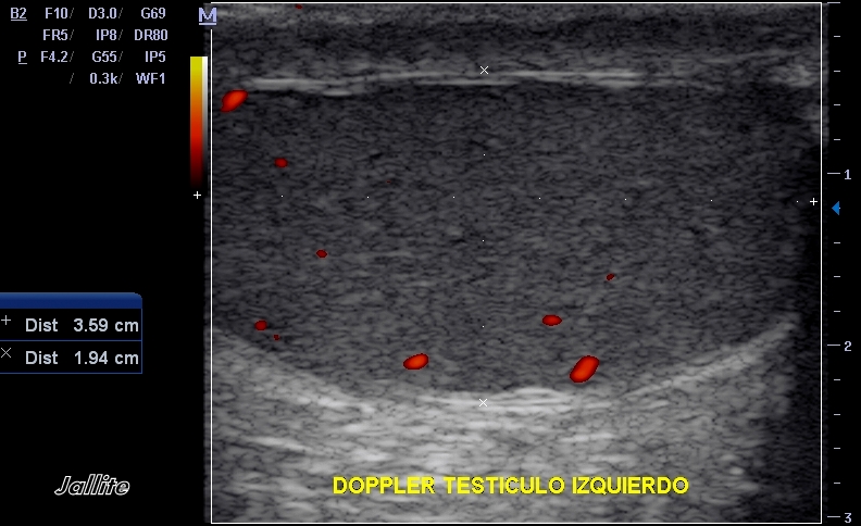 Engrosamiento Escrotal post Absceso