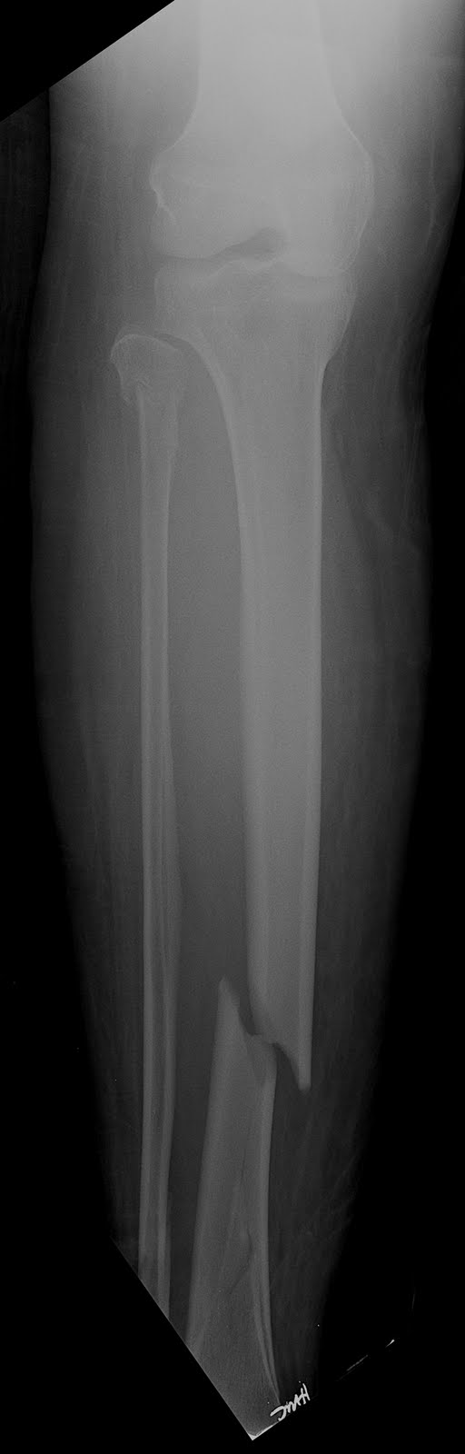 Complex Tibia Fracture ~ Orthopaedi