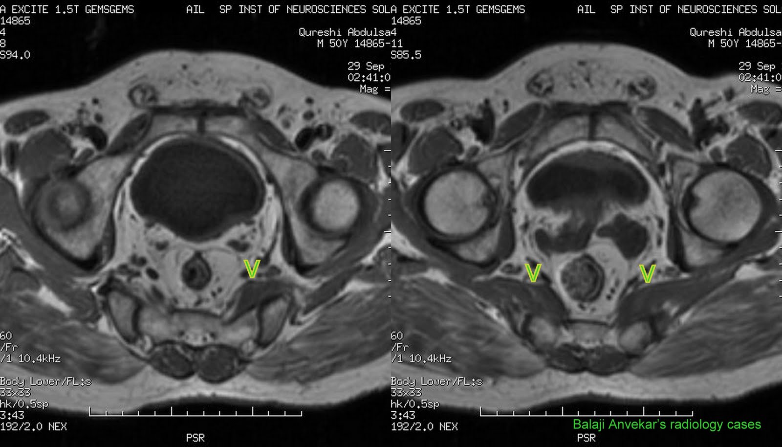 Dr Balaji Anvekar's Neuroradiology Cases: Pyriformis syndrome MRI