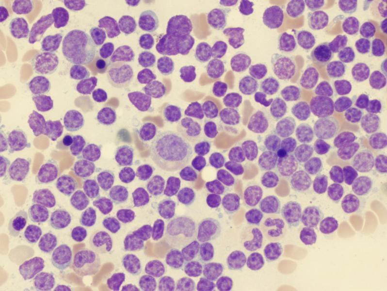 Fichero de Hematologia: Leucemia Linfoide Aguda