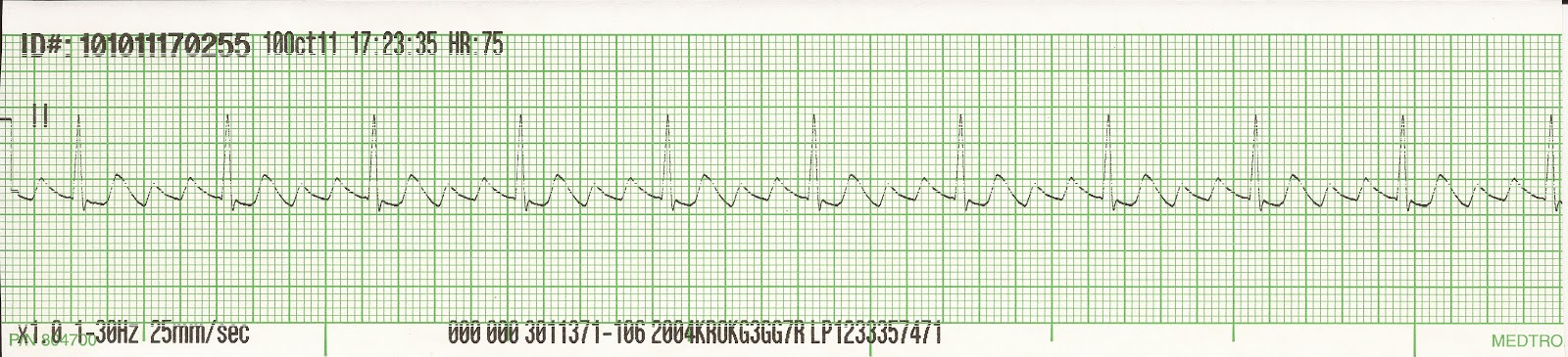 Float Nurse: EKG Rhythm Strips 85: Atrial Flutter