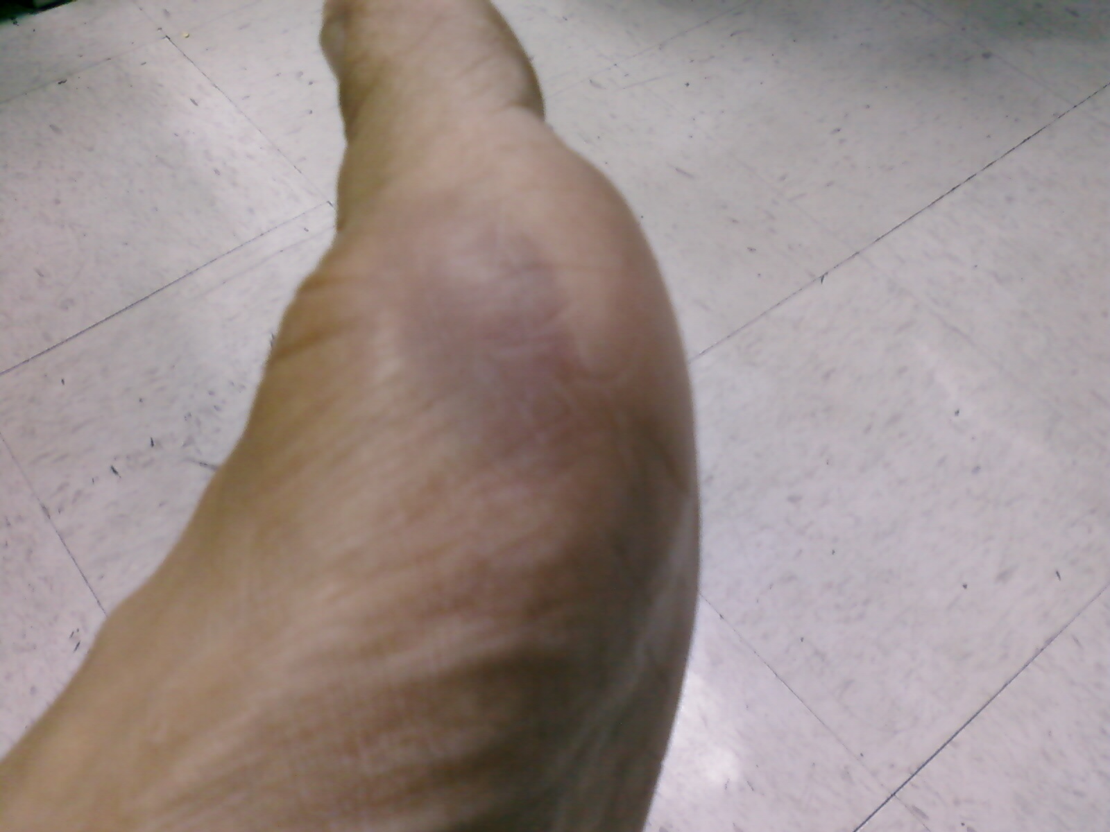 Confessions of a 30 year-old: Of Bruises and Poles...
