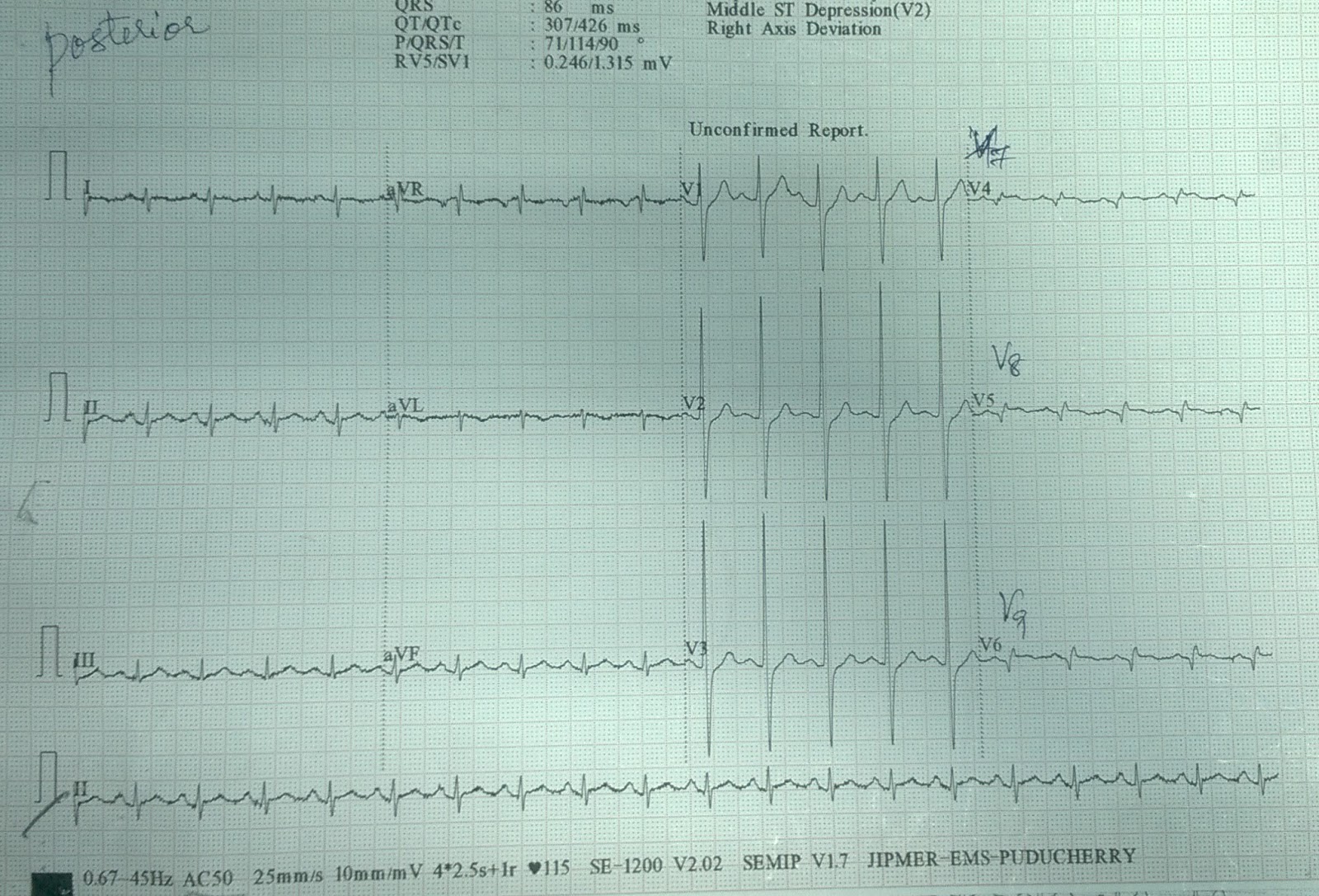 Cardiology window: Posterior wall myocardial infarction with inferior ...